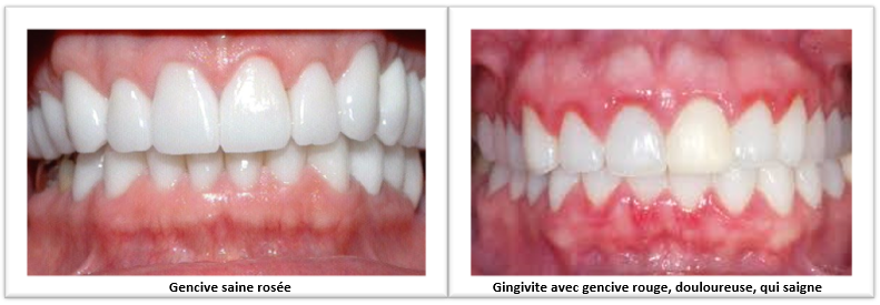 La maladie parodontale, qu'est ce que c'est