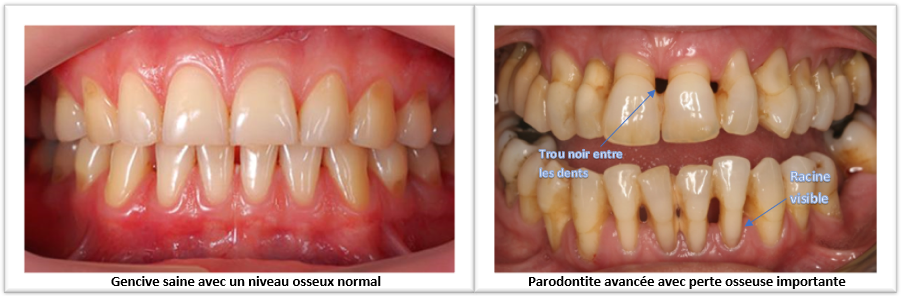 La maladie parodontale, qu'est ce que c'est